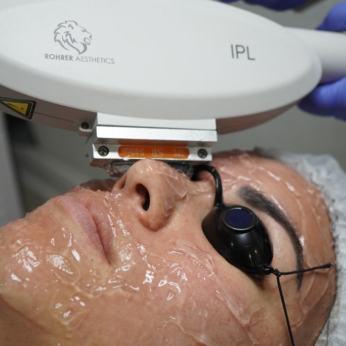 IPL Photofacial | Aesthetics | The Vitality Co.